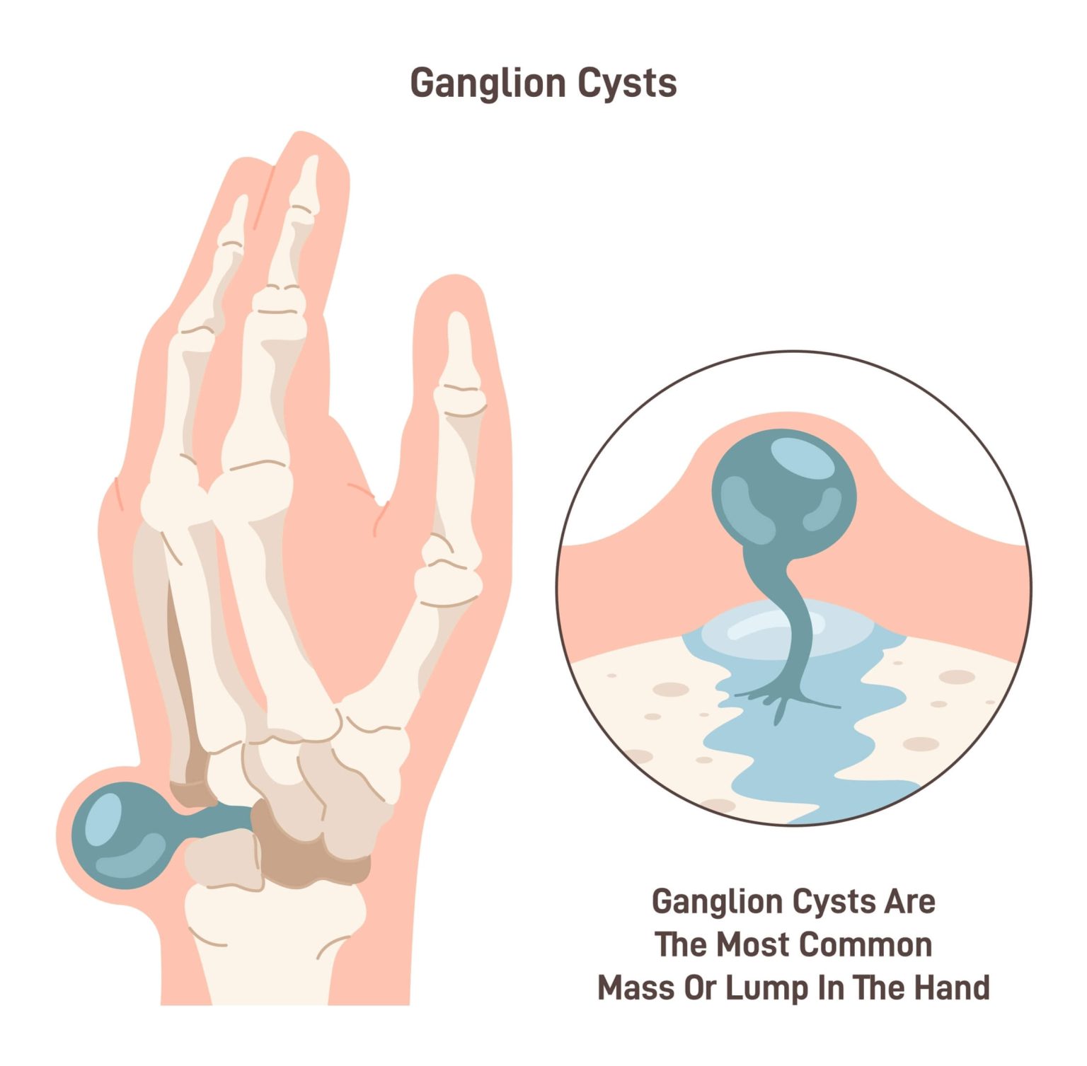 Ganglion pols | Symptomen, Oorzaken en Behandeling
