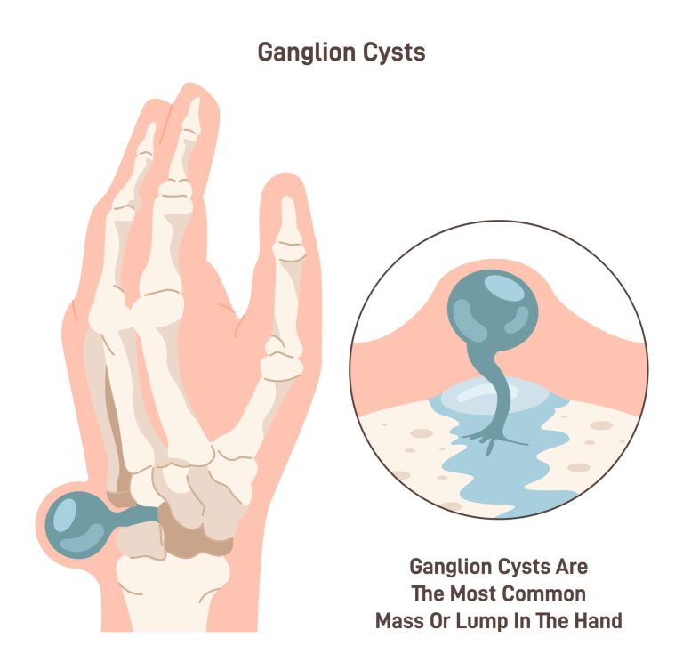 Ganglion pols | Symptomen, Oorzaken en Behandeling